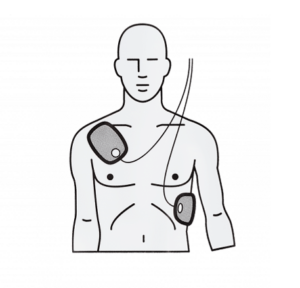Défibrillateur : Comment et où placer les électrodes ? - D+ SERVICES